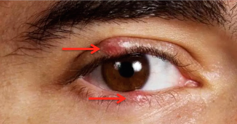 Colloidal Silver Heal Eye Infections Fast - How To Use It Safely And ...